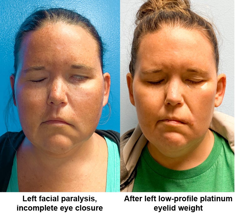 Platinum Eyelid Weight Placement | UNC Facial Nerve Center