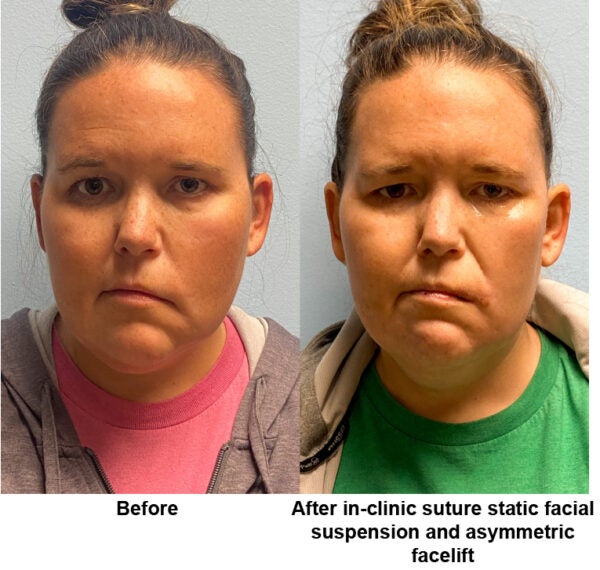 Fascia Lata Facial Suspension | UNC Facial Nerve Center