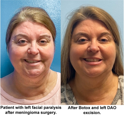 Vestibular Schwannomas Aka Acoustic Neuromas Unc Facial Nerve Center