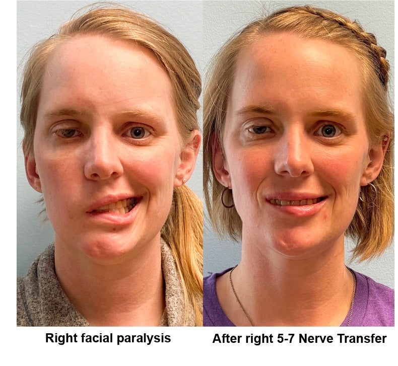 5-7 Nerve Transfer Smile Reanimation | UNC Facial Nerve Center